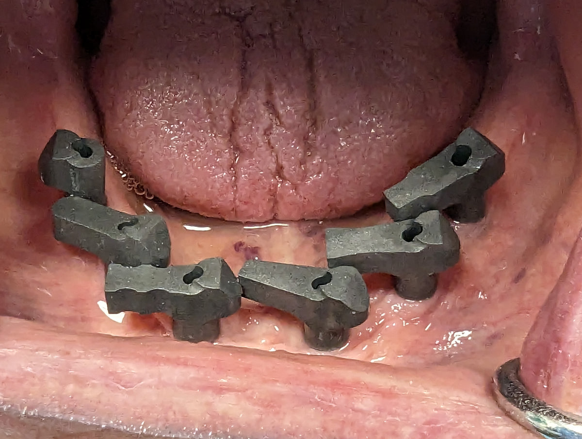 ArchBridge™ IOS Package - Scan Bodies, Screws & Driver– ROE Dental ...