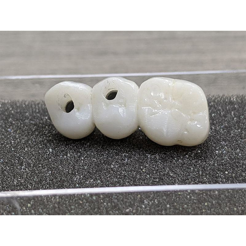 TLZ-SR Bridge with Abutments– ROE Dental Laboratory