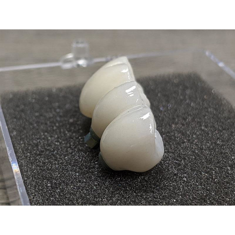 TLZ-SR Bridge with Abutments– ROE Dental Laboratory