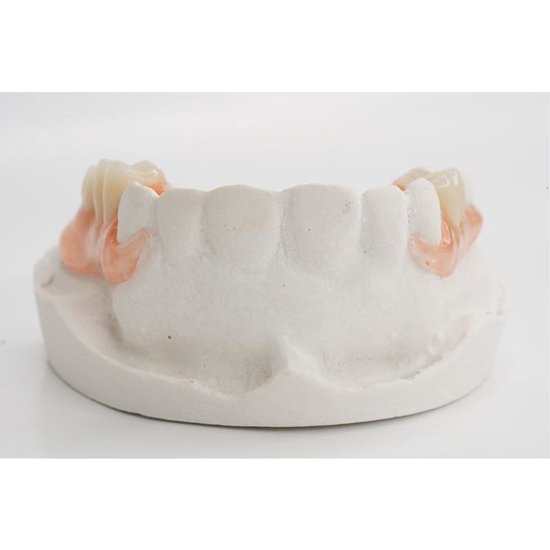 Valplast Partial (Upper)– ROE Dental Laboratory