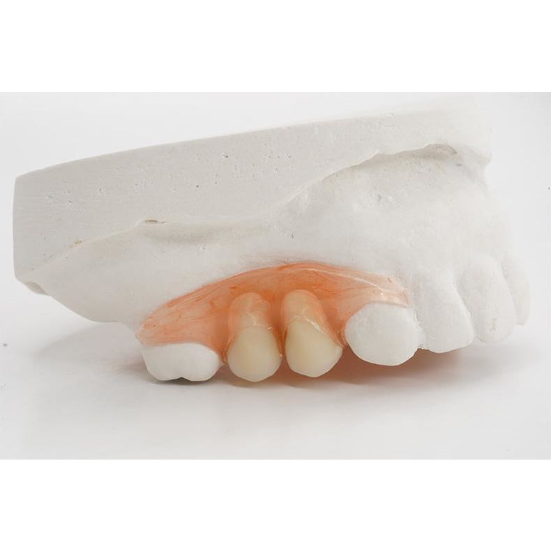 Valplast Partial (Upper)– ROE Dental Laboratory