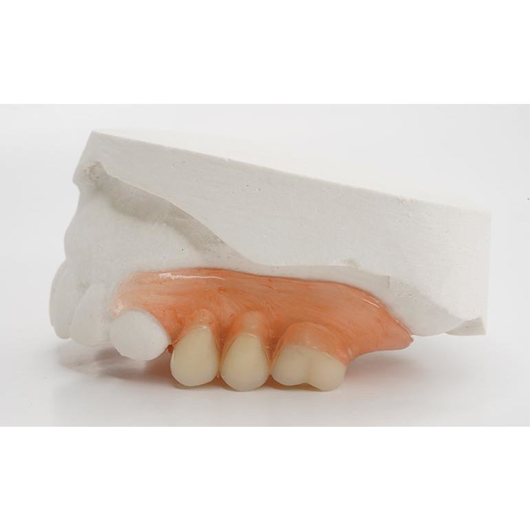 Valplast Partial (Upper)– ROE Dental Laboratory