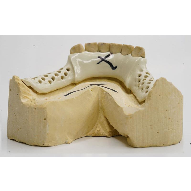 Acetal Frame (Mandible)– ROE Dental Laboratory
