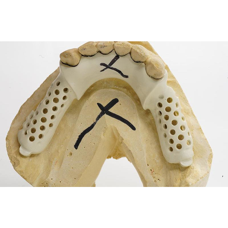 Acetal Frame (Mandible)– ROE Dental Laboratory