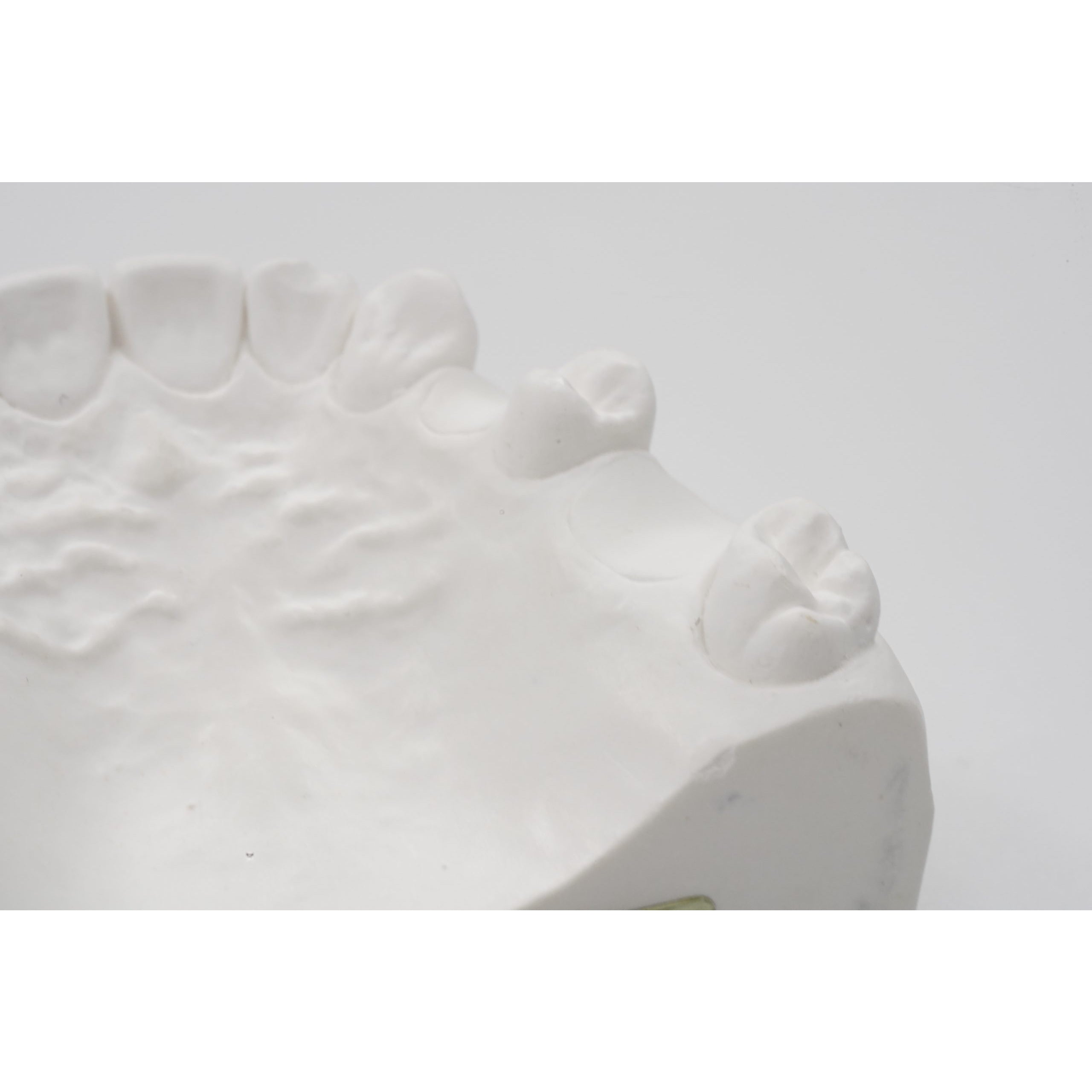 Snap-On Smile Partial– ROE Dental Laboratory