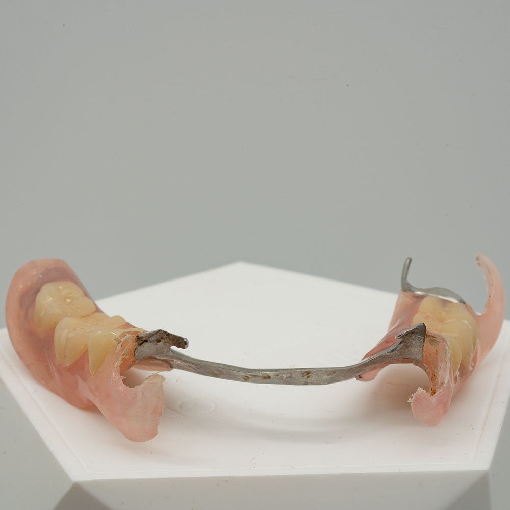 Valplast Partial Hybrid (Maxilla)– ROE Dental Laboratory